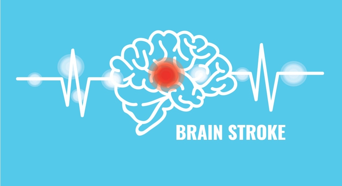 What You Need To Know About Stroke - A Cardiovascular Disease